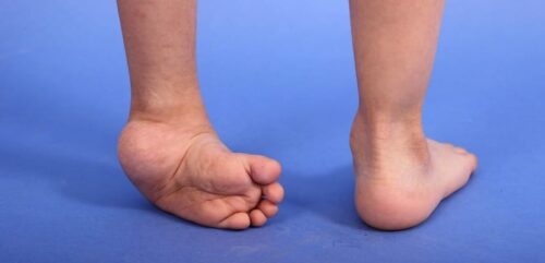 Spanish doctors design the first 3D splints to treat clubfoot